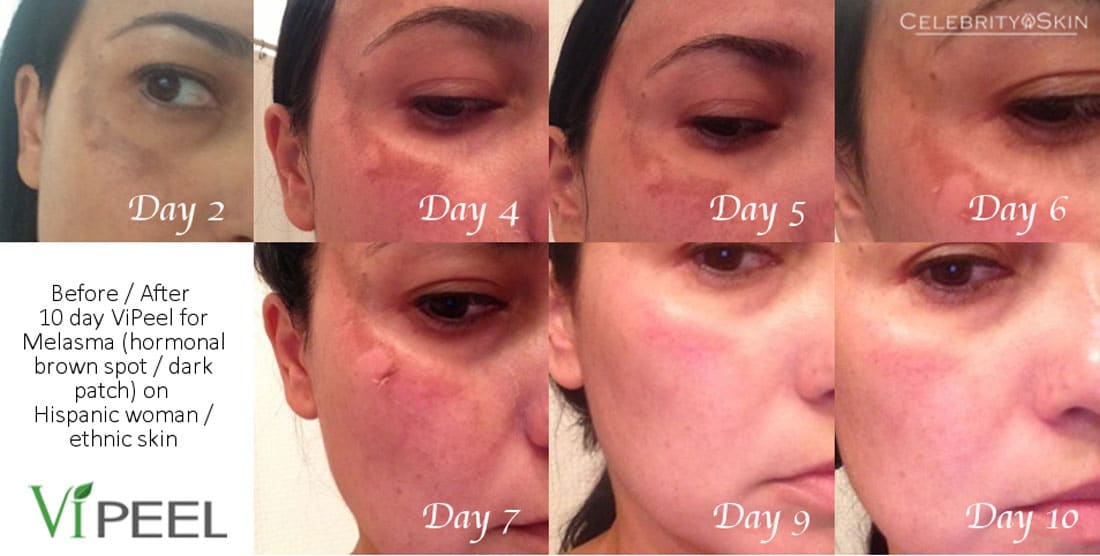 Skin of Color | Ethnic and Darker Skin Tones Facial Treatments